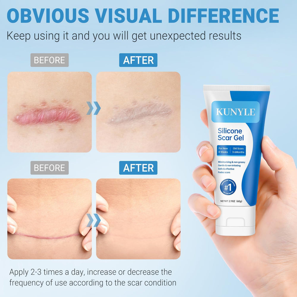 Kunyle Silicone Scar Gel – Advanced Scar Care for Surgical Scars, Kelo ...